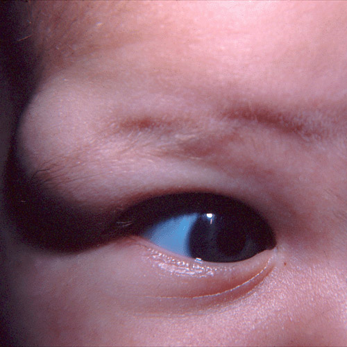 Dermoid Cyst Containing Eye